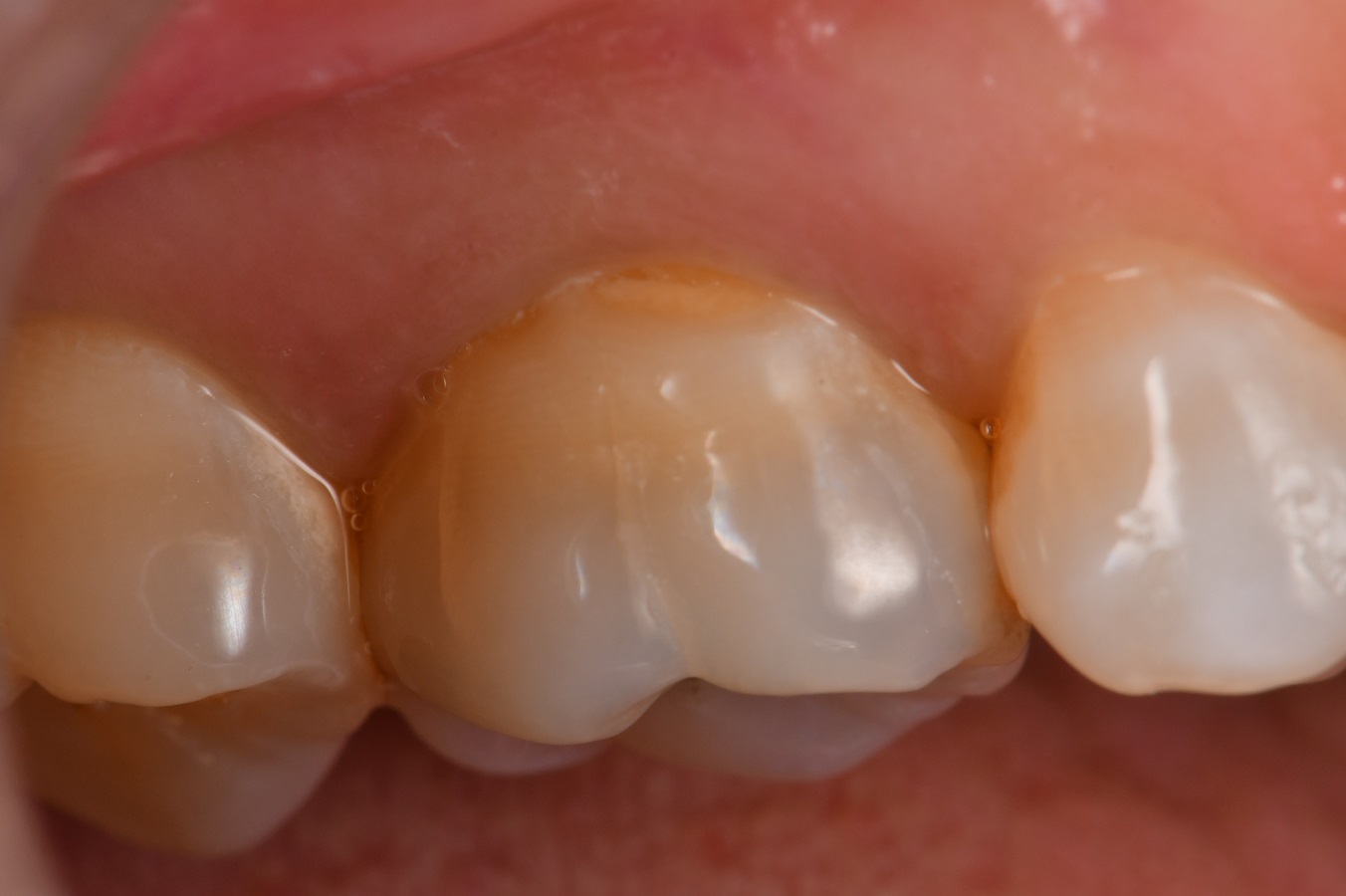 Revirginization of Teeth with Bonded Composite