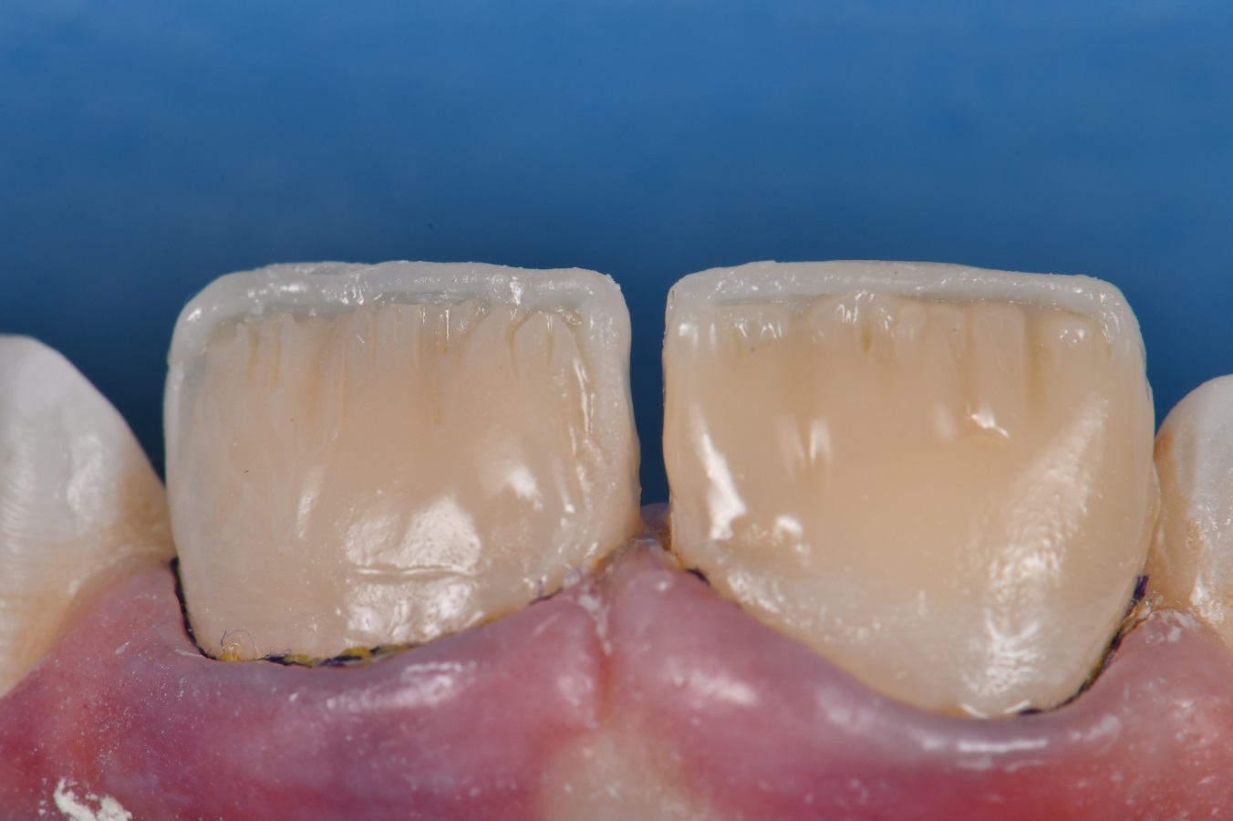Complex Composite Reconstruction of a tooth post trauma