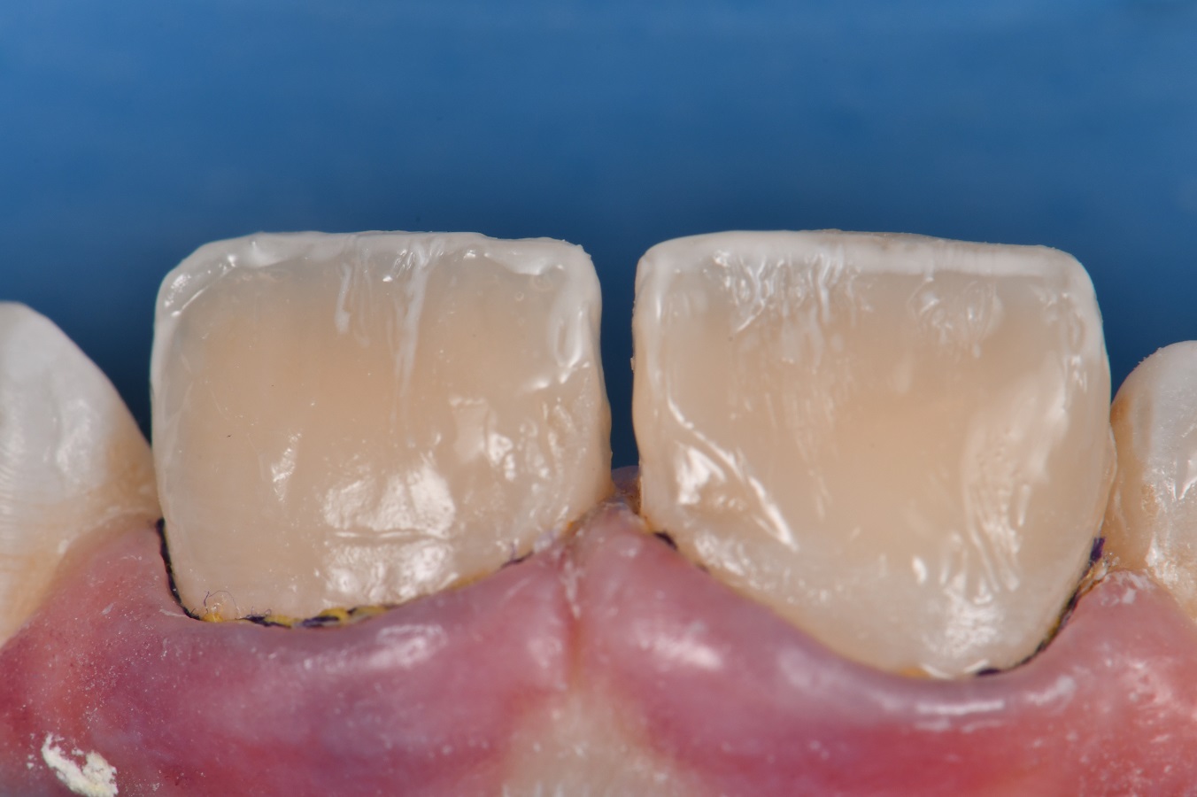 Complex Composite Reconstruction of a tooth post trauma