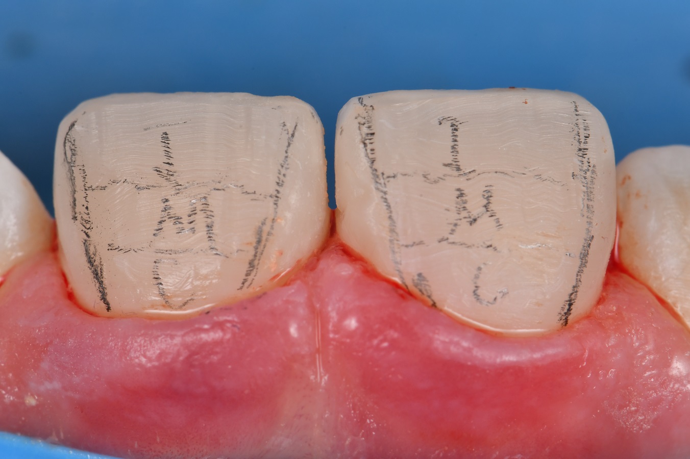 Complex Composite Reconstruction of a tooth post trauma