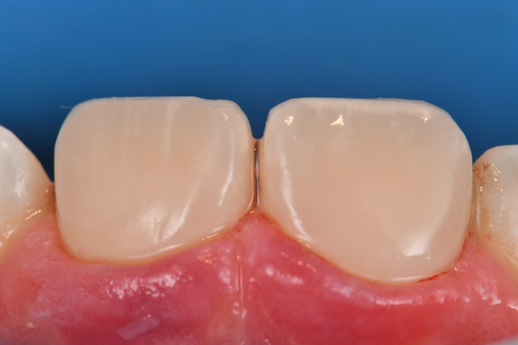 Complex Composite Reconstruction of a tooth post trauma