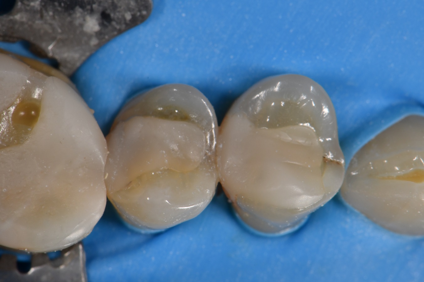 The Matrix in Matrix technique in dental restorations