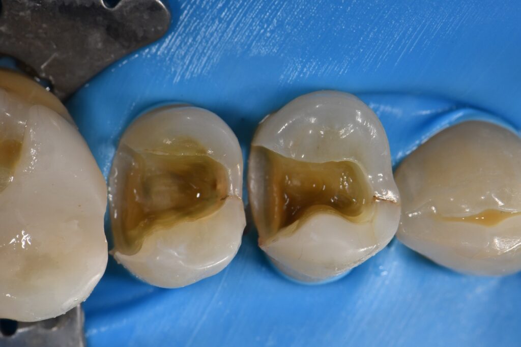 The Matrix in Matrix technique in dental restorations