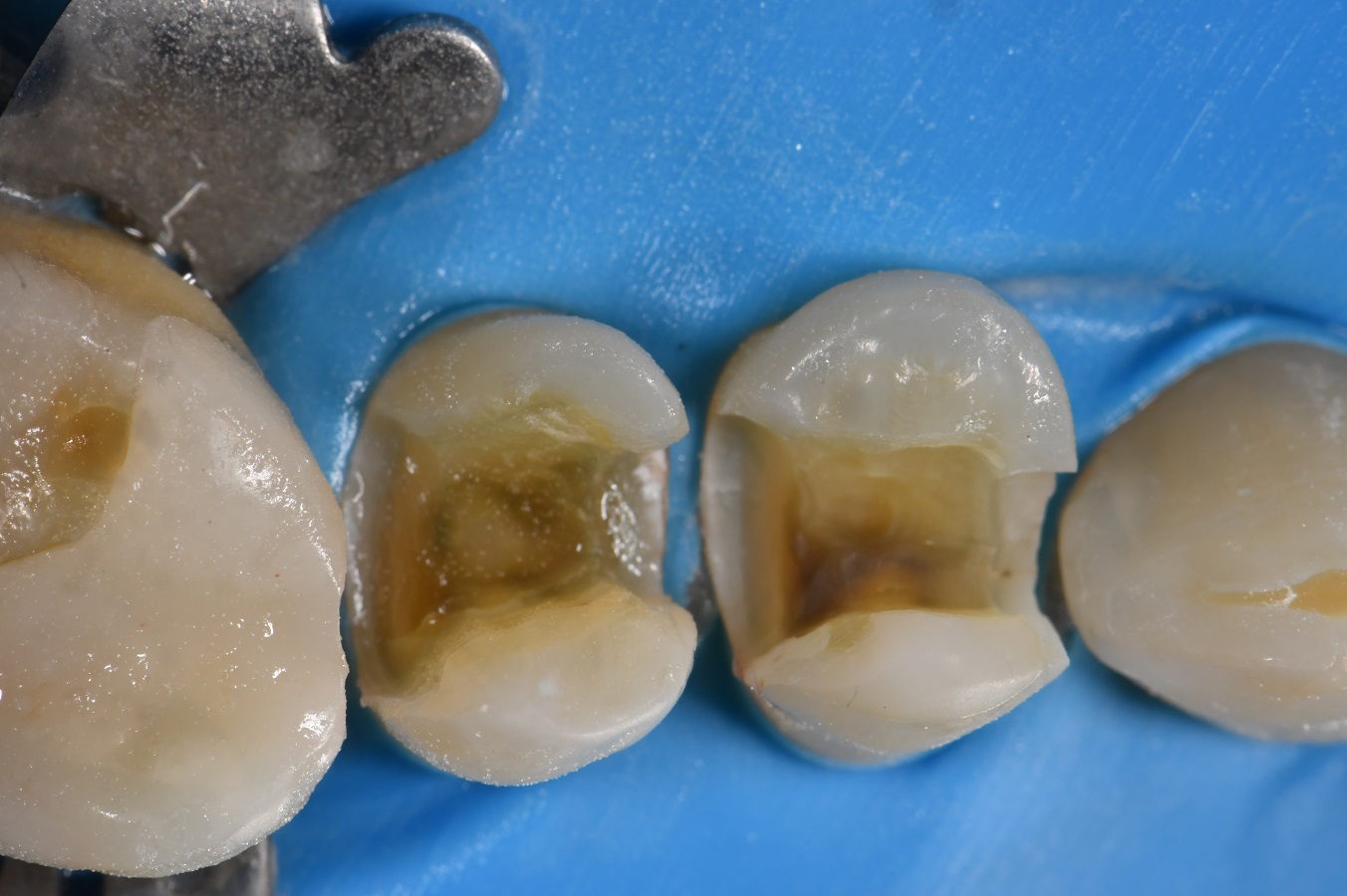 The Matrix in Matrix technique in dental restorations