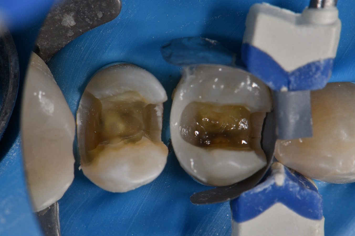 The Matrix in Matrix technique in dental restorations