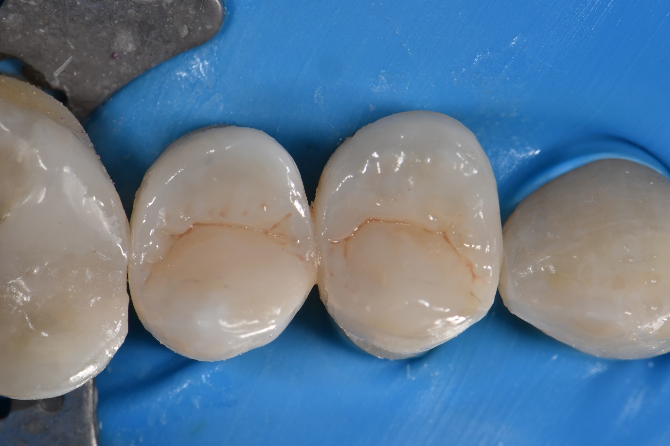 The Matrix in Matrix technique in dental restorations