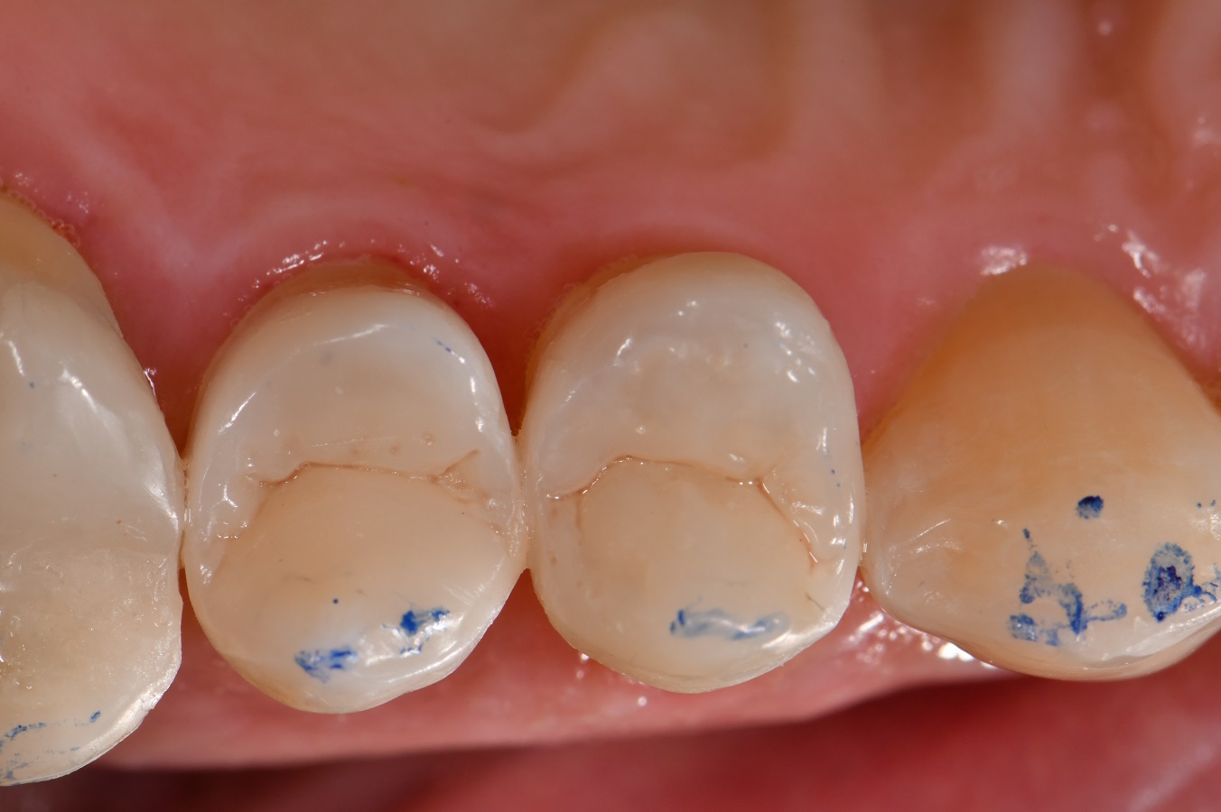 The Matrix in Matrix technique in dental restorations