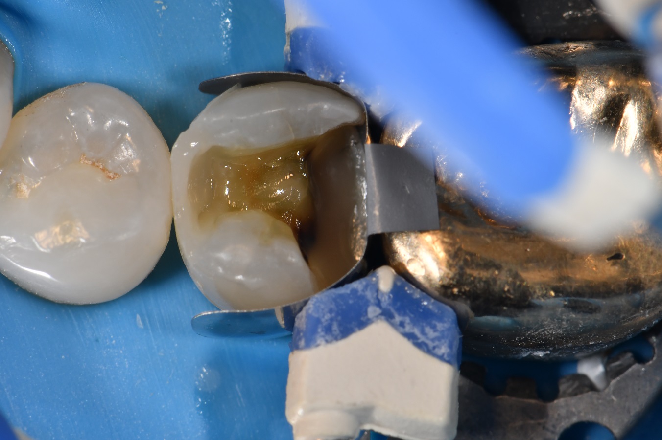 Did you know that Dental Amalgam induces crack formation