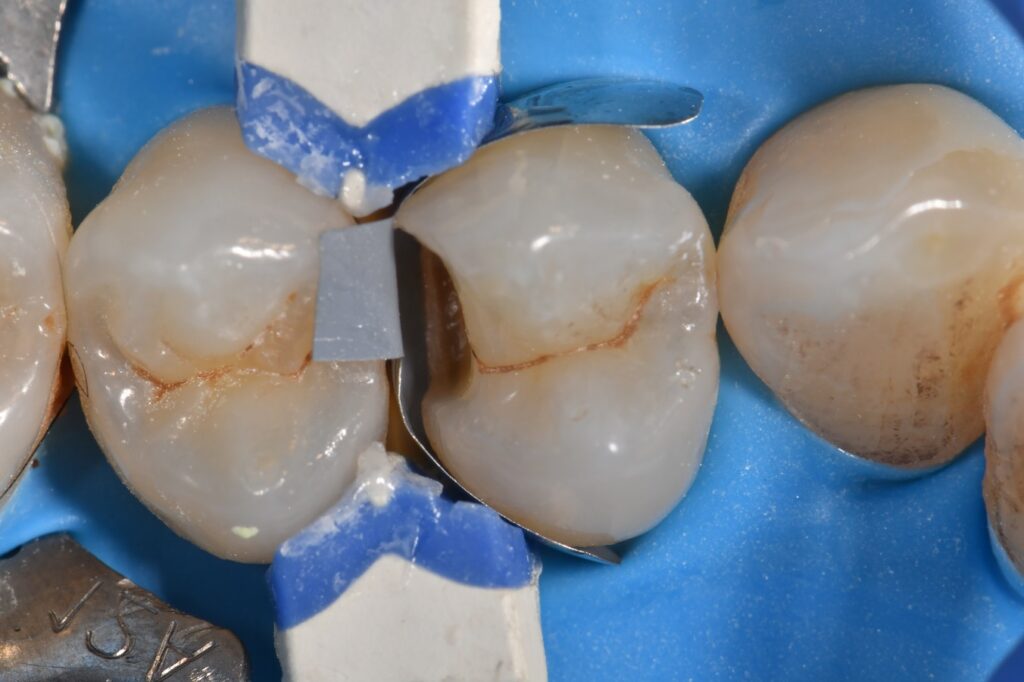 Using the Garrison Compositight matrix system