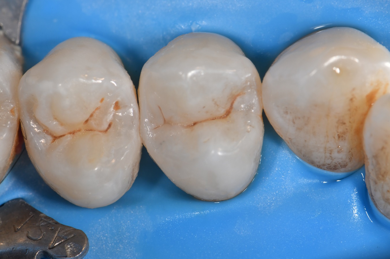 Using the Garrison Compositight matrix system