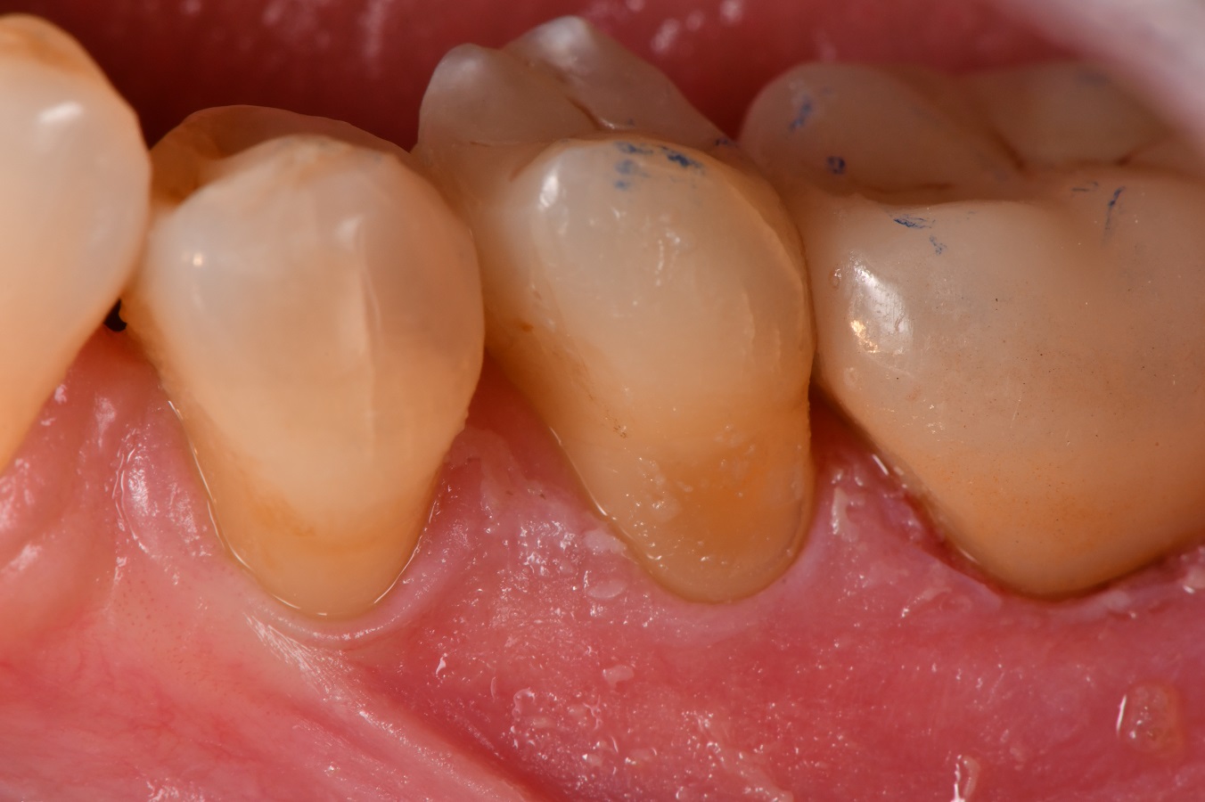 Biomimetic composite in the cervical third