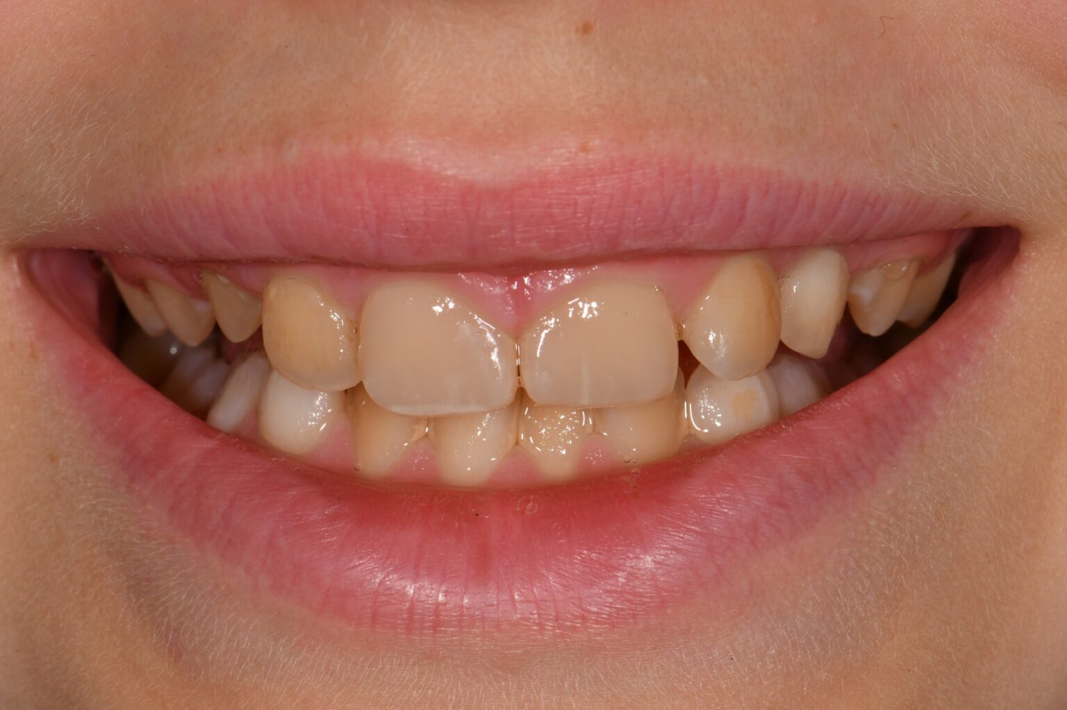 Restoring Fractures and restoring confidence with composite layering