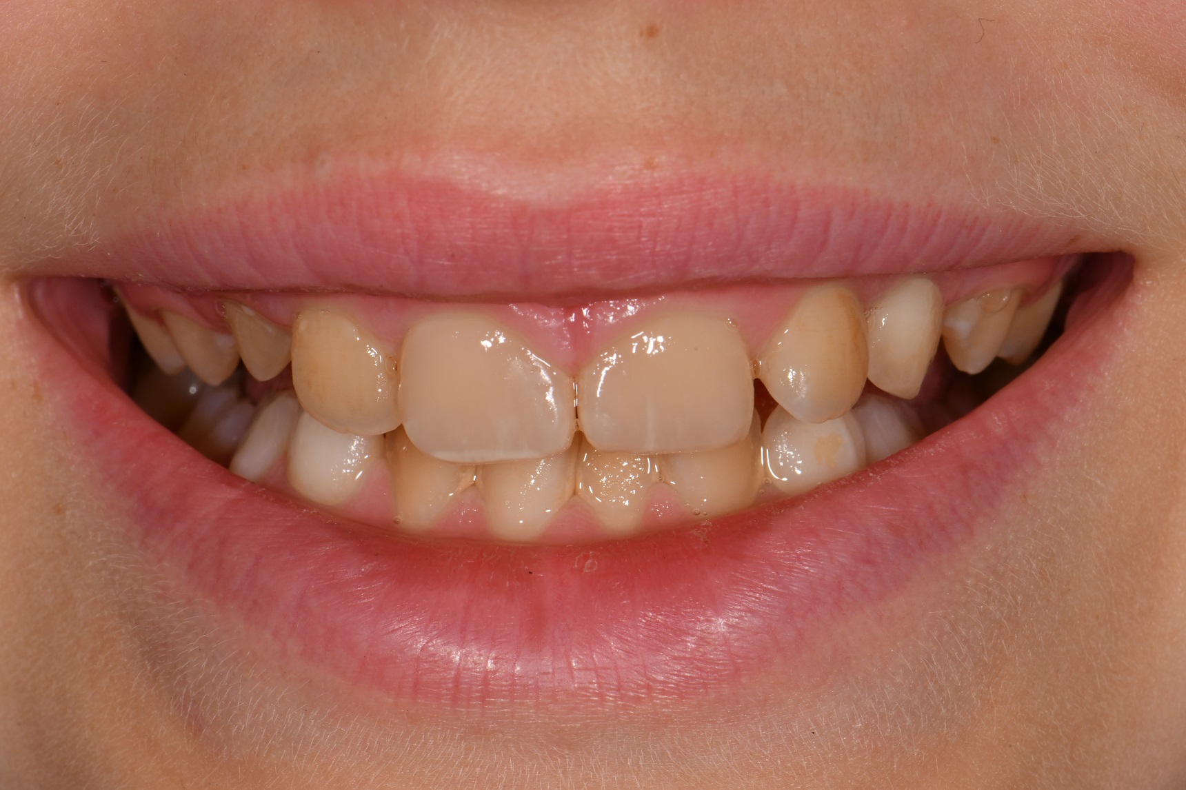 Restoring Fractures and restoring confidence with composite layering