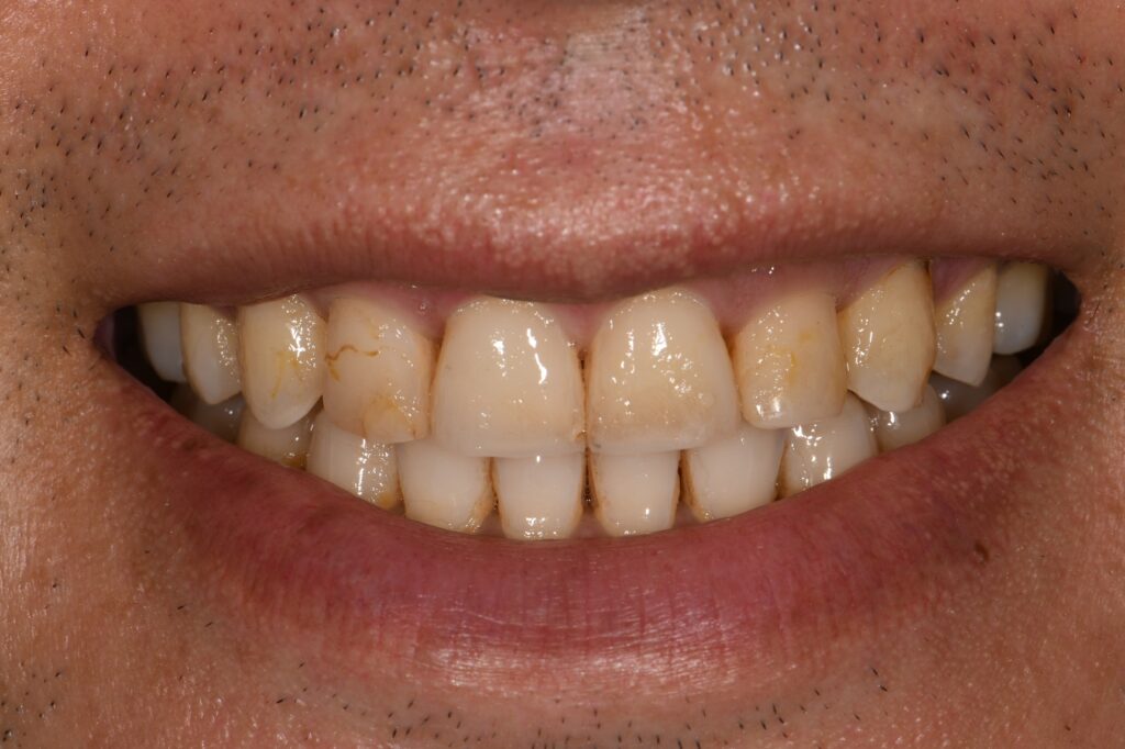 Smile Design that Changes The Personality of your Face