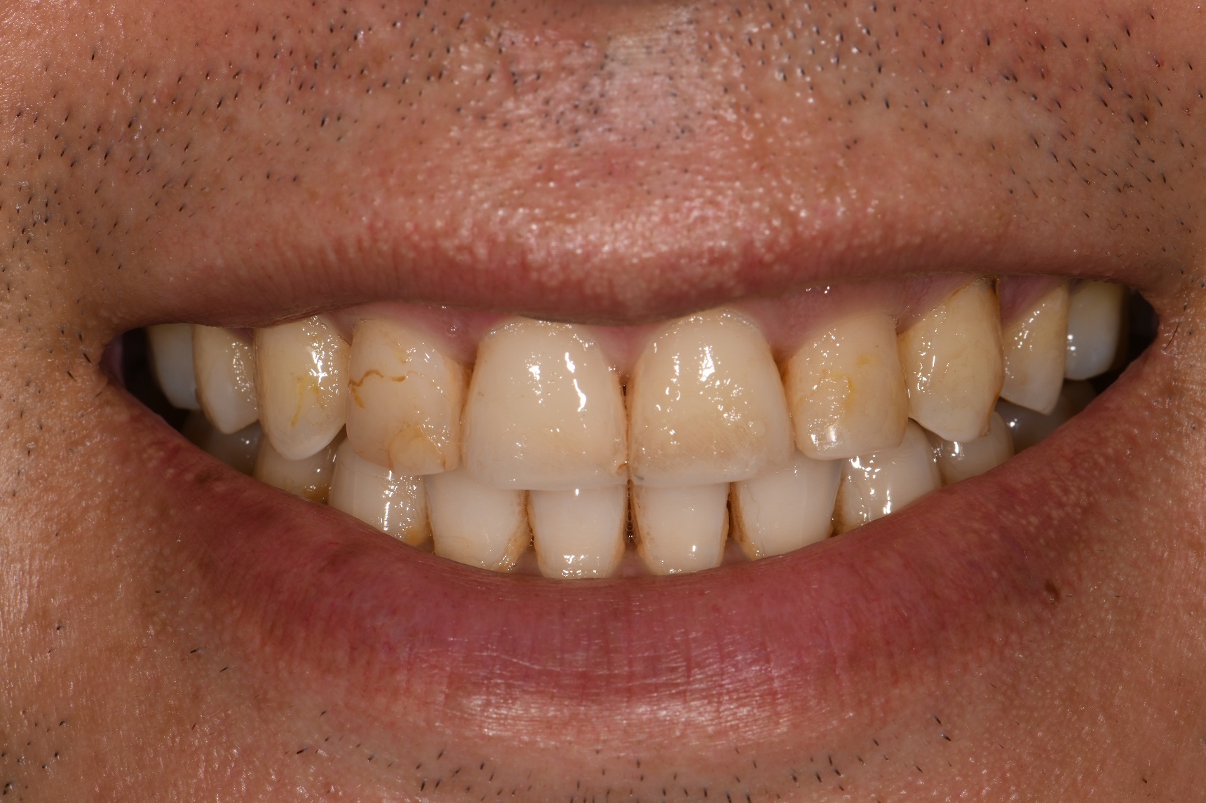 Smile Design that Changes The Personality of your Face