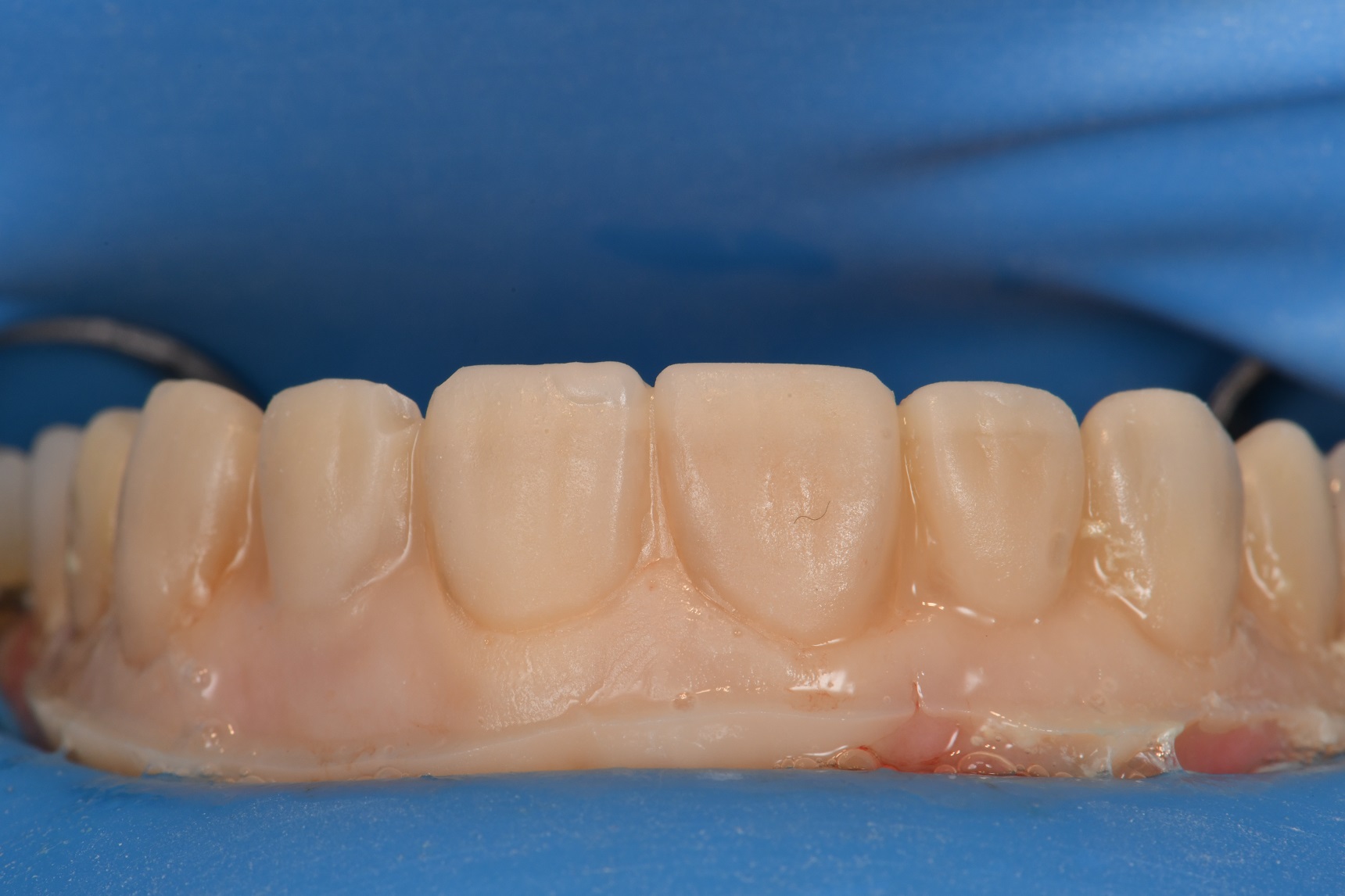 Orthodontics and Veneers with a Maryland Bridge design