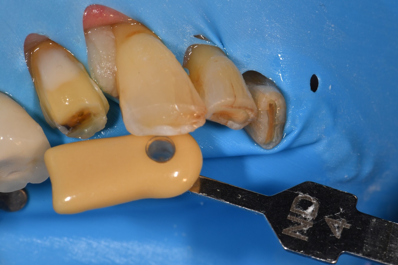 Conservative Zirconia Crown