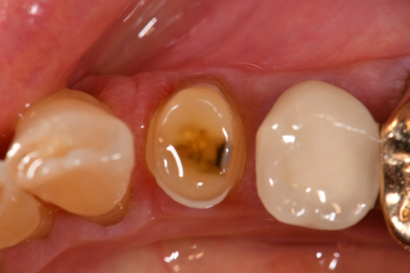 Conservative Zirconia Crown