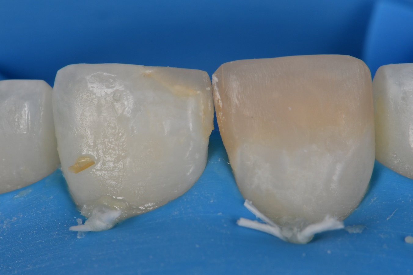 Replacement Composite Restorations in a trauma case