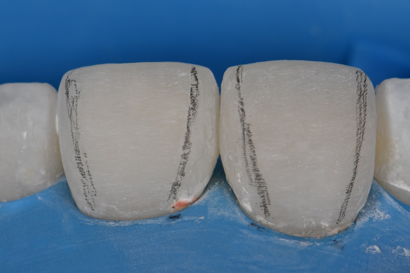 Replacement Composite Restorations in a trauma case