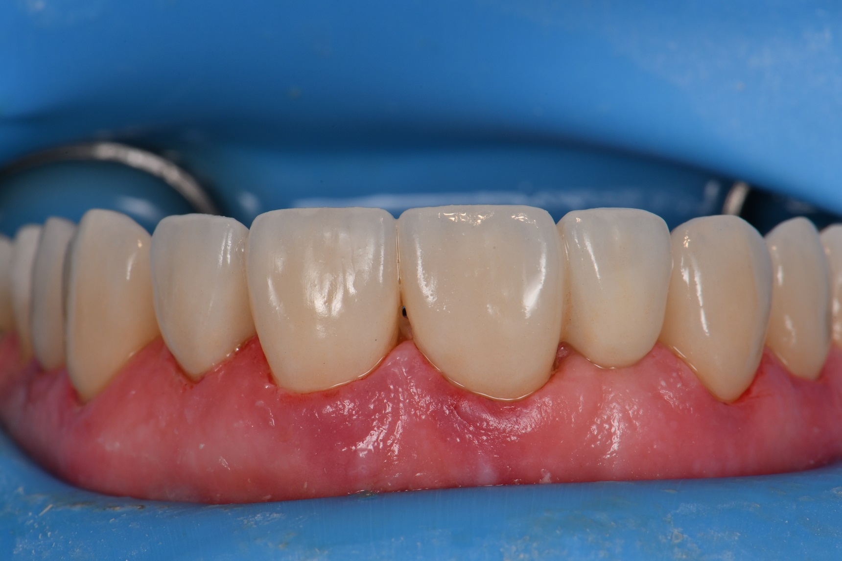 Orthodontics and Veneers with a Maryland Bridge design
