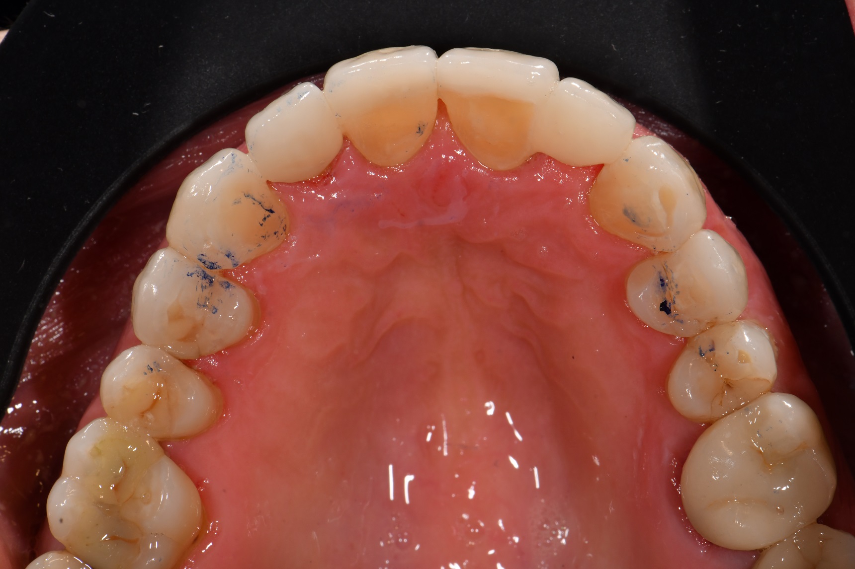 Orthodontics and Veneers with a Maryland Bridge design