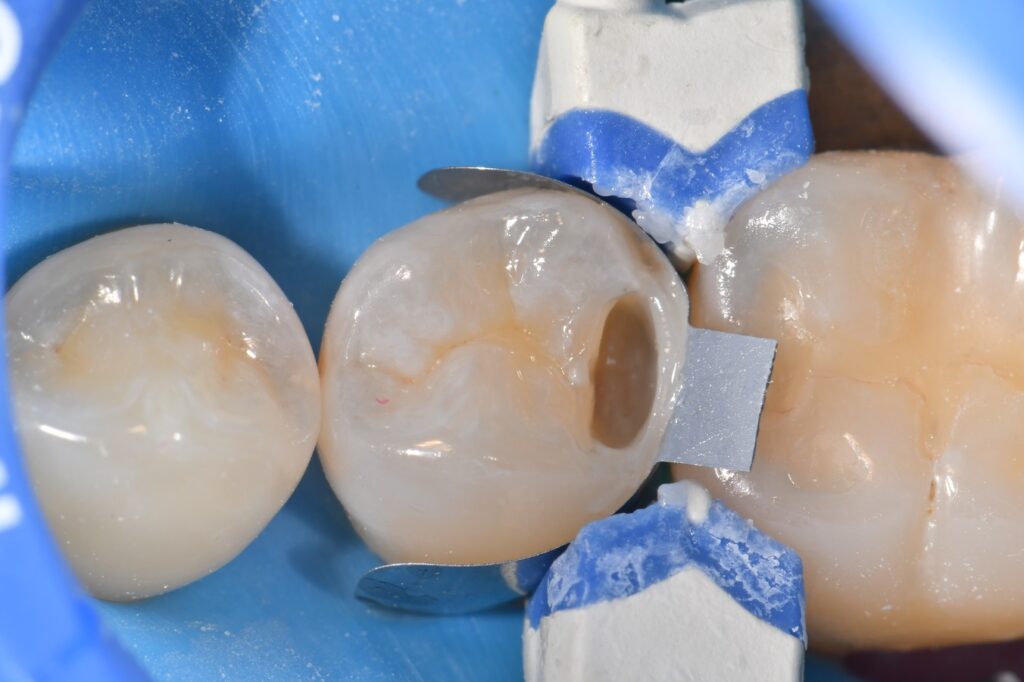 When to use Garrison Strata G and Compositight 3D Fusion