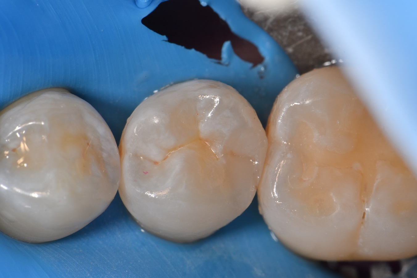 When to use Garrison Strata G and Compositight 3D Fusion