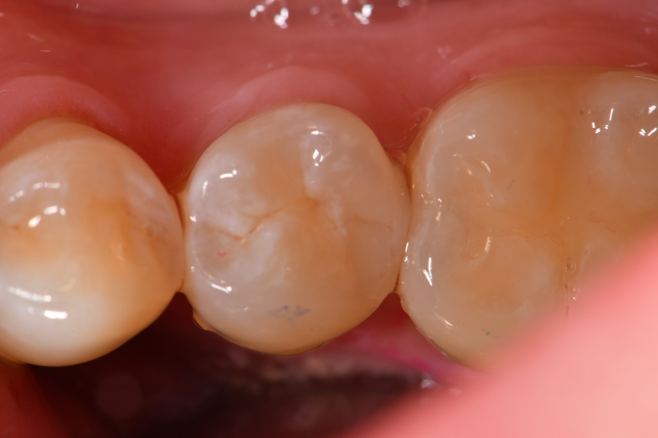 When to use Garrison Strata G and Compositight 3D Fusion