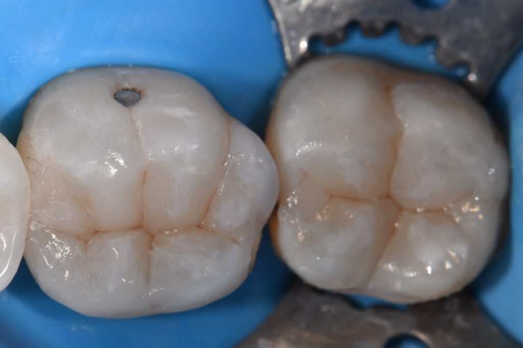 Supercomposite use in large enamel and dentin structural defects