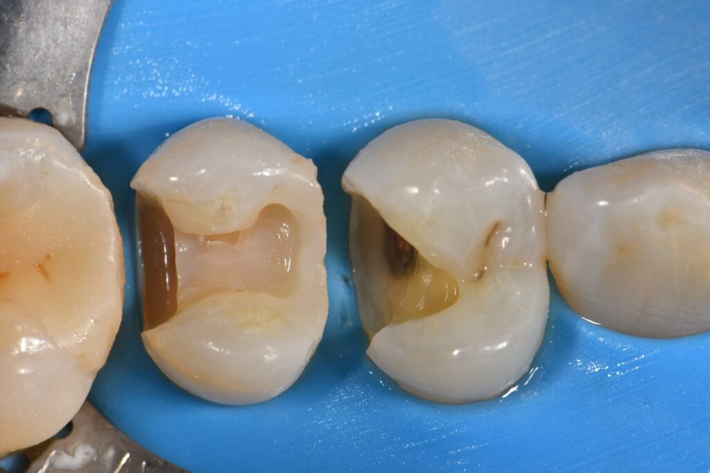Closing large gaps between teeth with Strata-G Closing large gaps between teeth with Strata-G