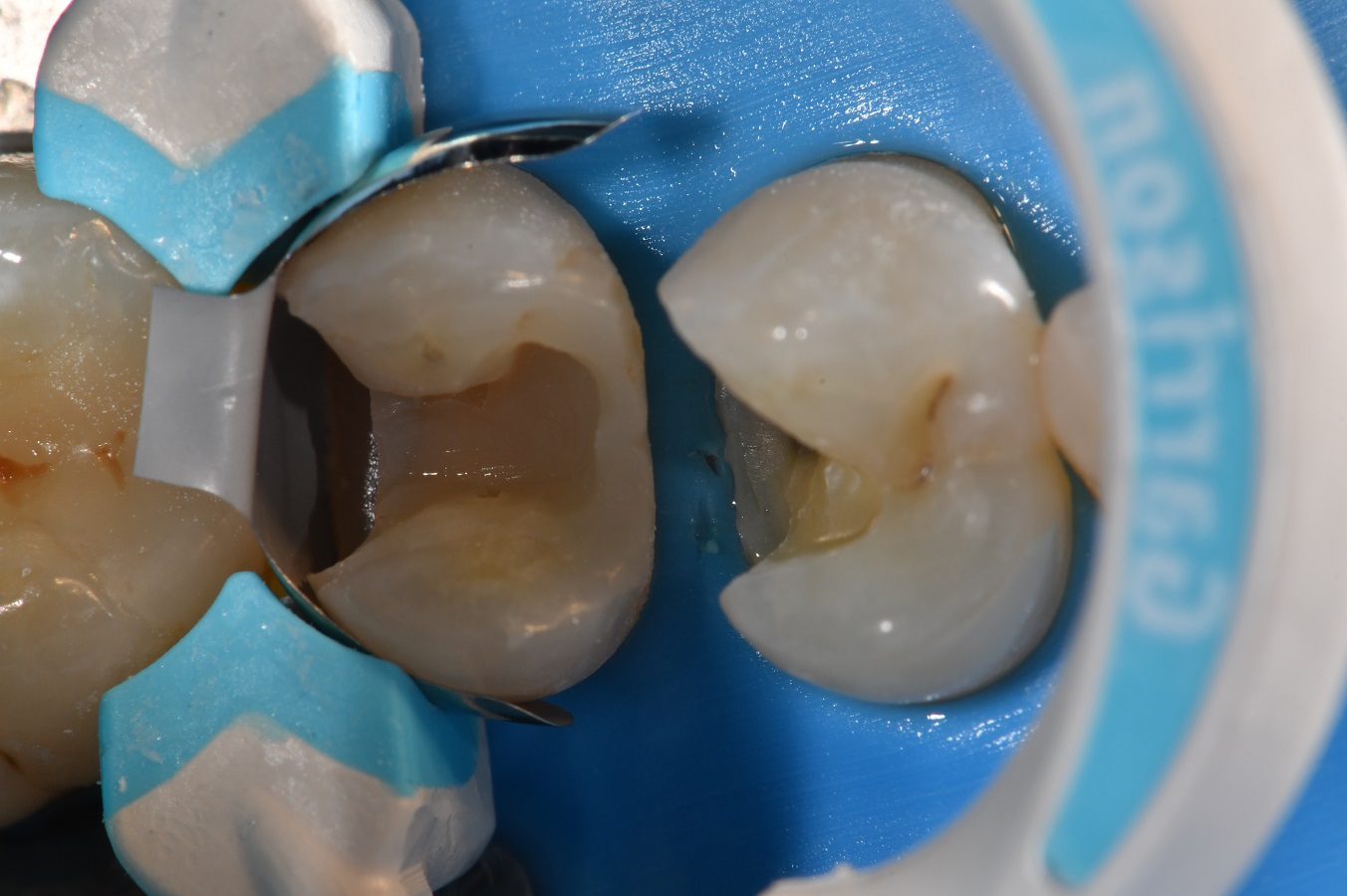 Closing large gaps between teeth with Strata-G Closing large gaps between teeth with Strata-G