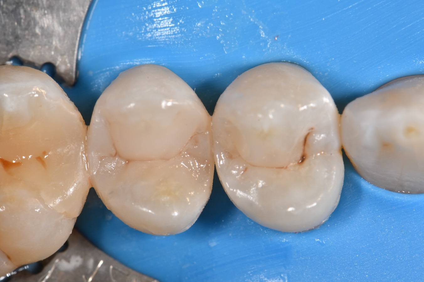 Closing large gaps between teeth with Strata-G Closing large gaps between teeth with Strata-G