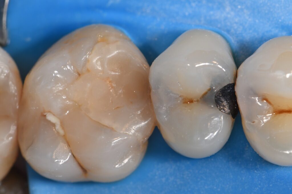 Using the Garrison Wide Prep Ring with Voco Grandio SO