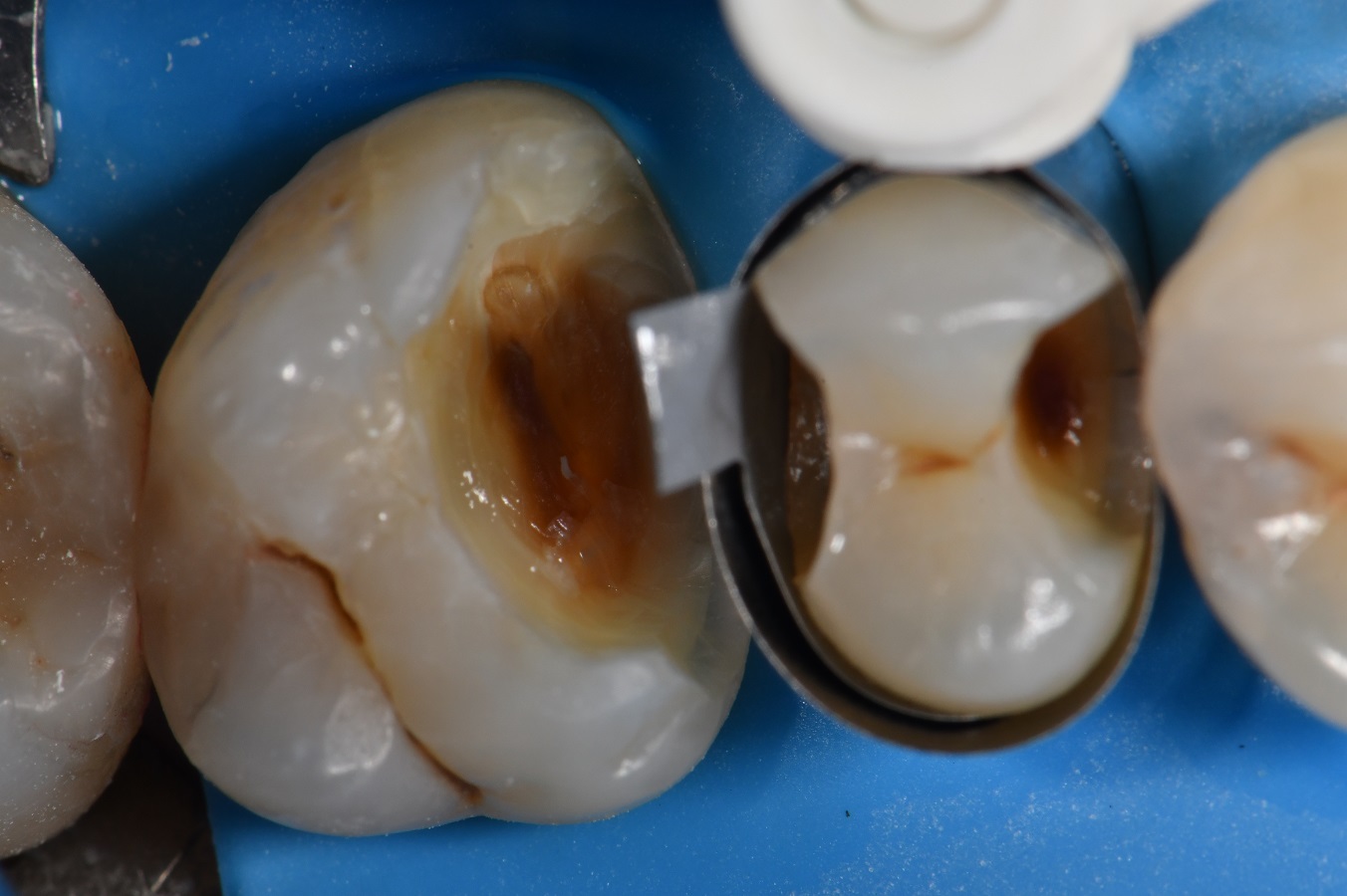 Using the Garrison Wide Prep Ring with Voco Grandio SO