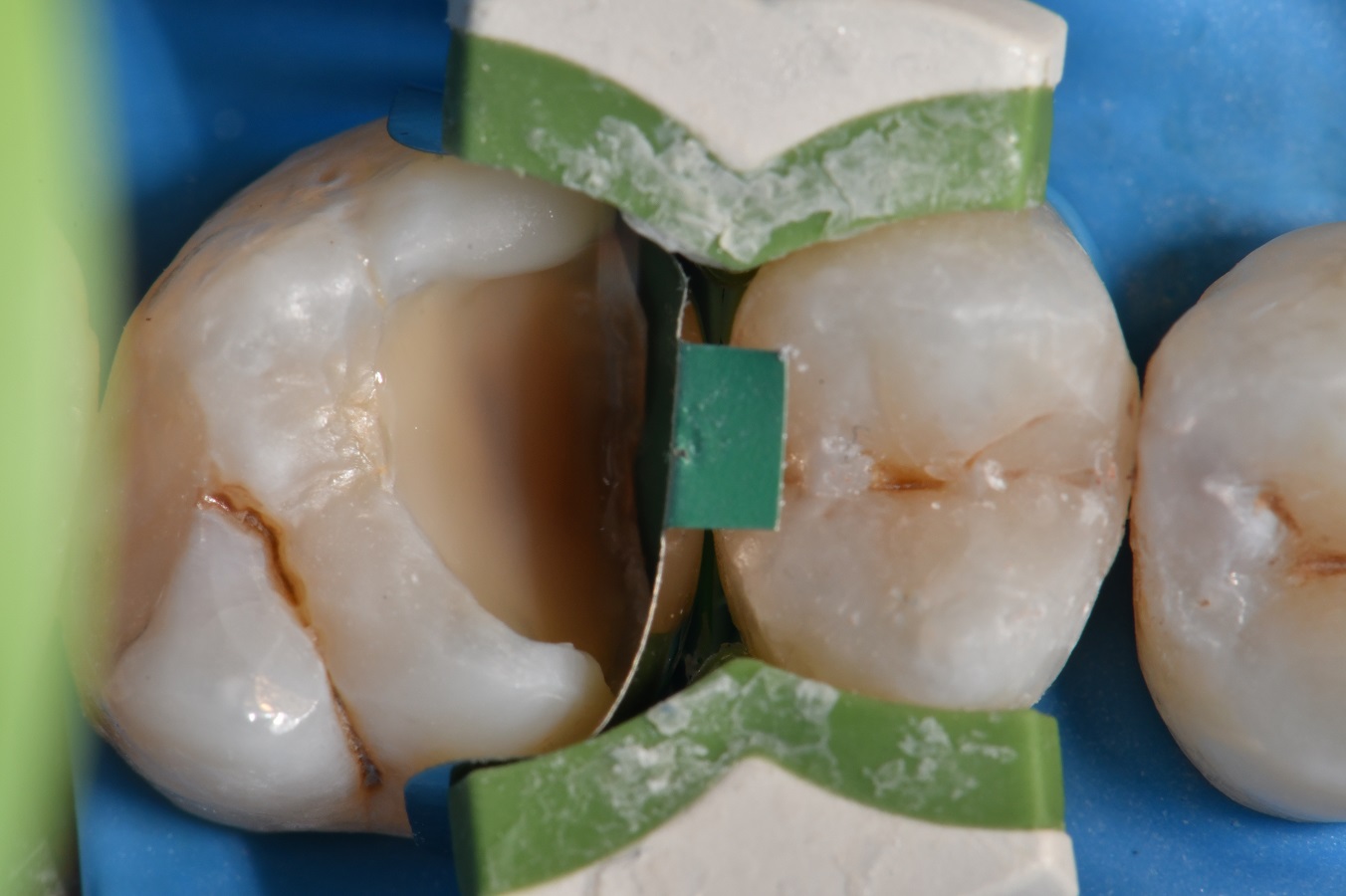 Using the Garrison Wide Prep Ring with Voco Grandio SO