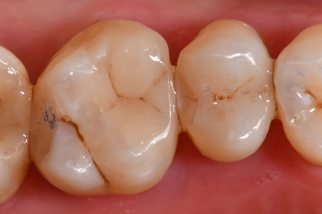 Using the Garrison Wide Prep Ring with Voco Grandio SO