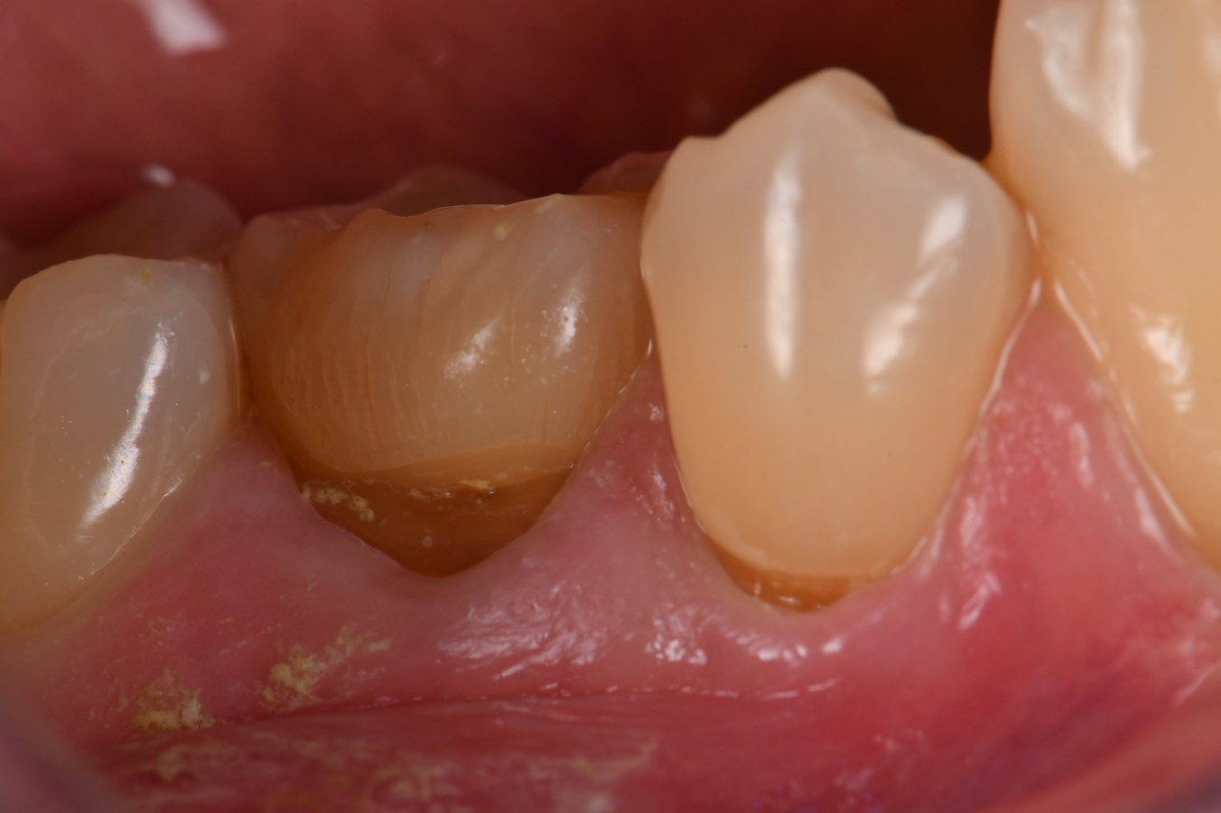 Making dental cervical abrasion a thing of the past