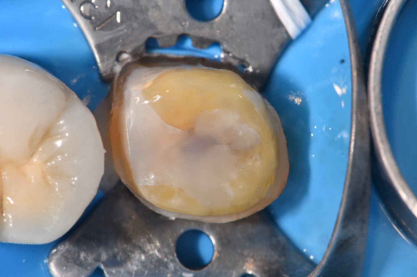 Preserving Tooth Structure in a Crown Preparation Design