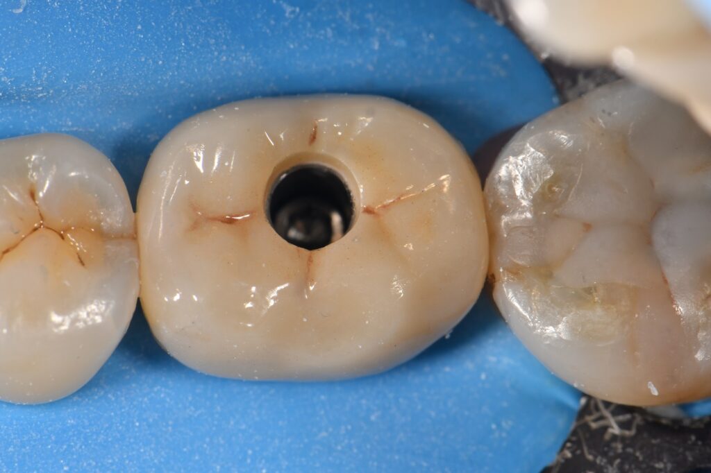 Implant screw access closure on a zirconia crown