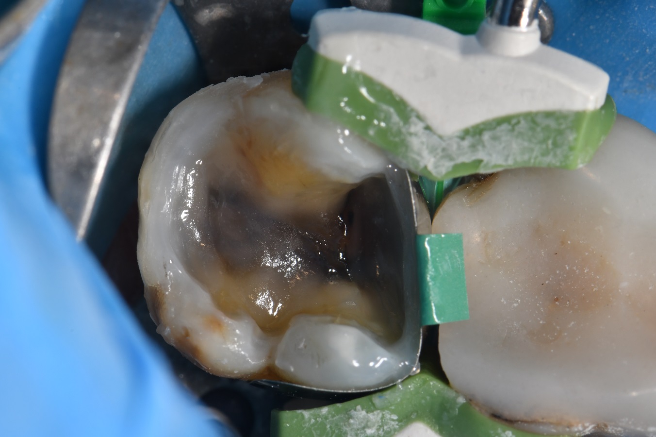 Voco Grandio SO Complex Reconstruction