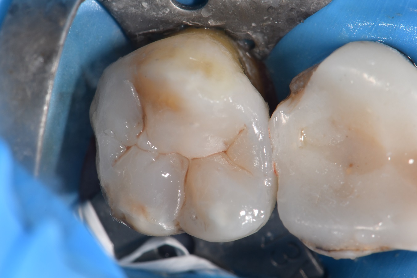 Voco Grandio SO Complex Reconstruction