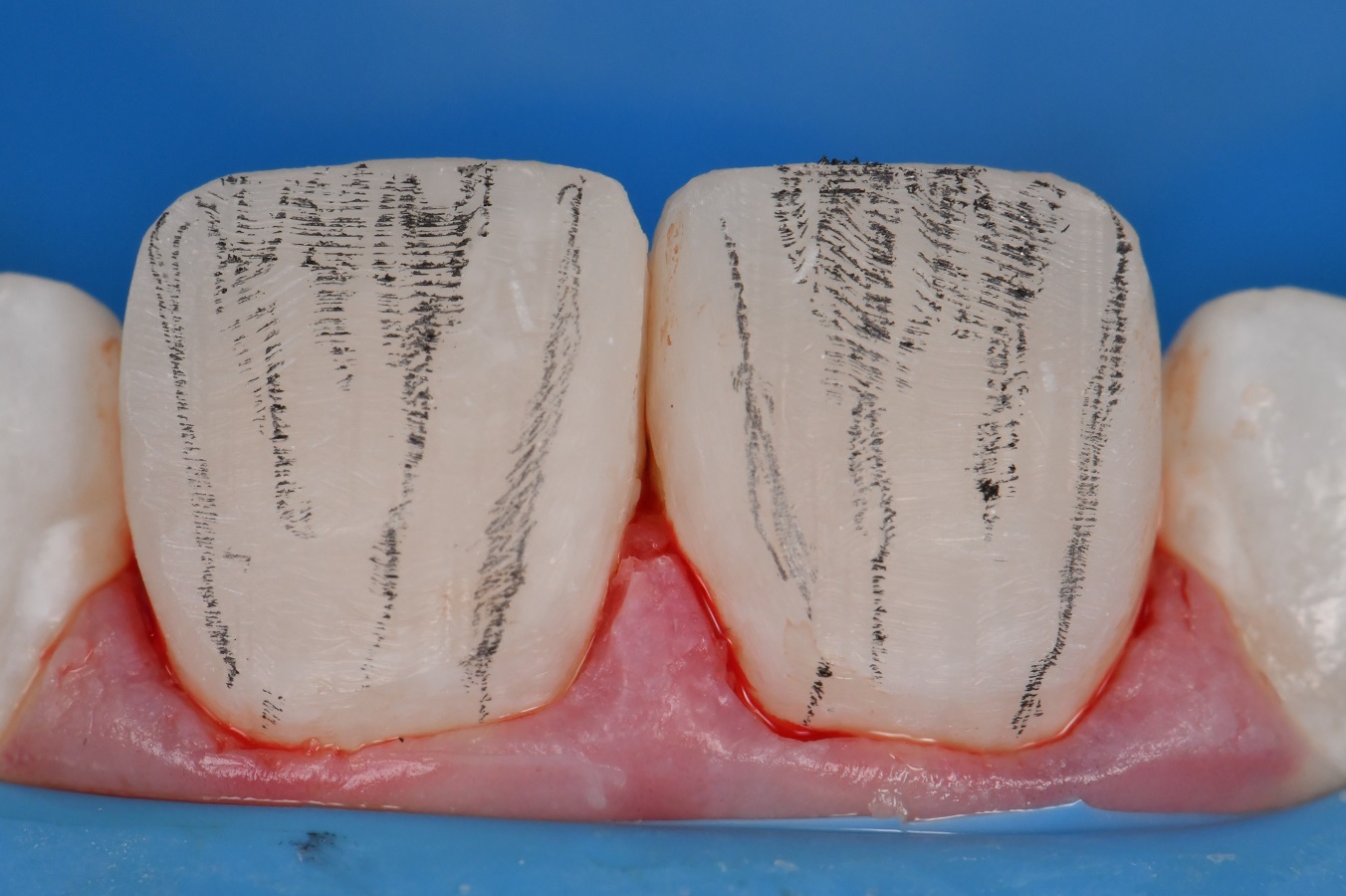 Rejuvenating old composite veneers
