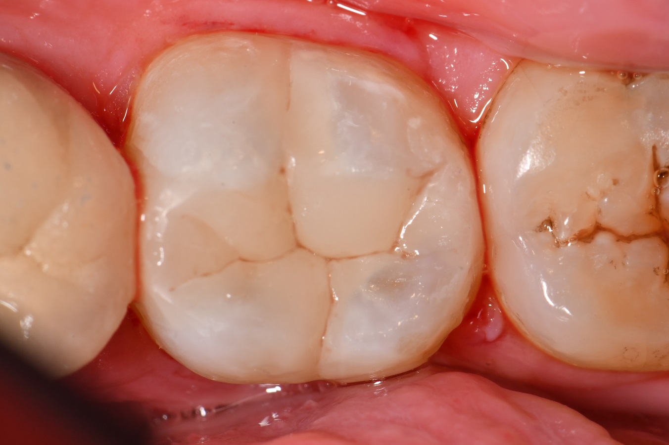 Supercomposite restoration of a crack compromised tooth