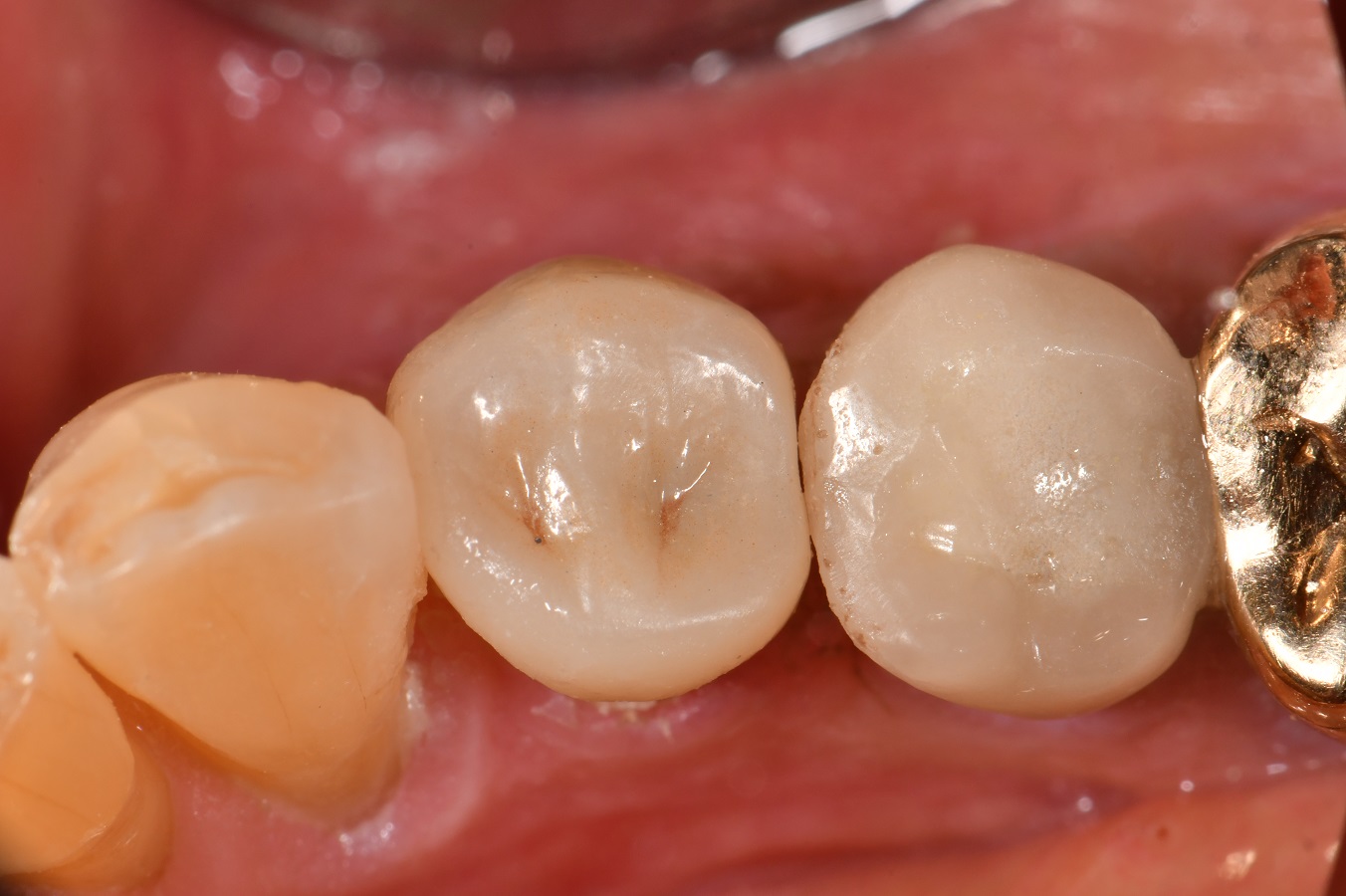 Conservative Zirconia Crown