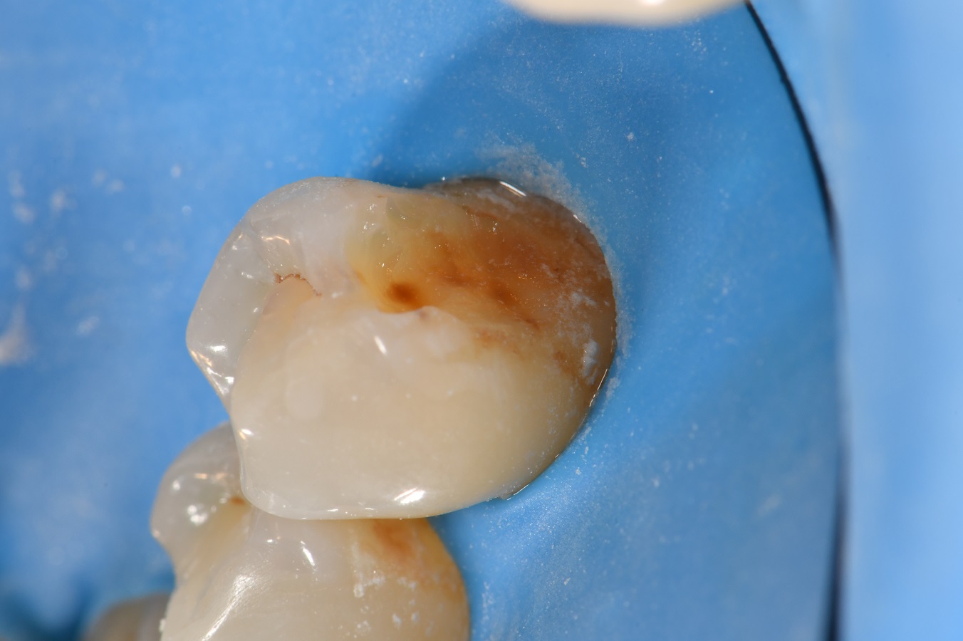 Treating Invasive Hypomineralization