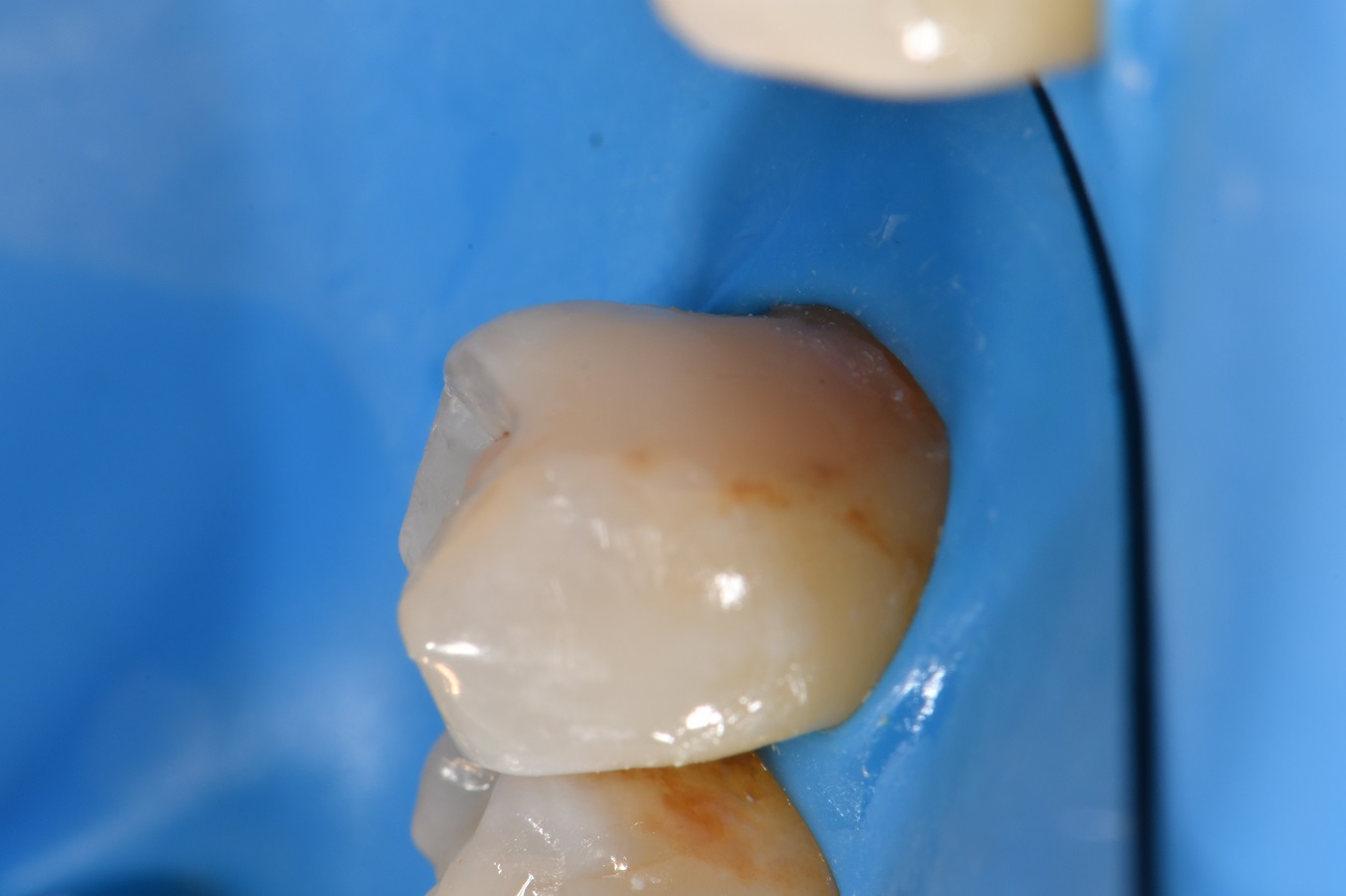 Treating Invasive Hypomineralization