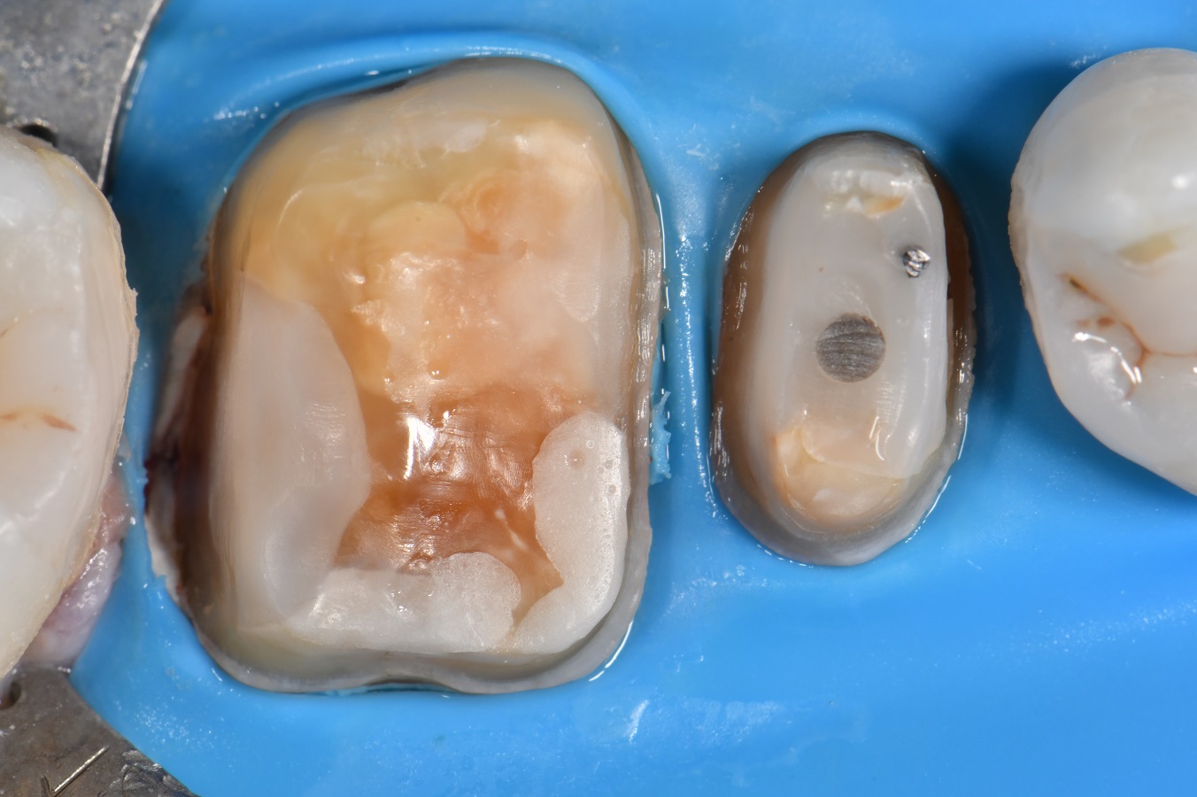 Crown Workflow with Core Partial Replacement