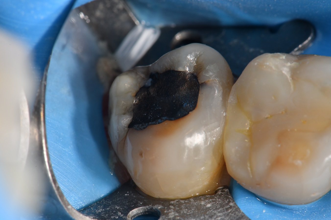 How to use Bioceramic sealer in a dental pulpotomy