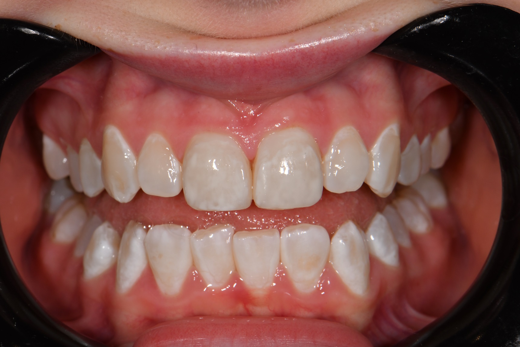 Mimicking Incisor Hypomineralization with Composite Veneers
